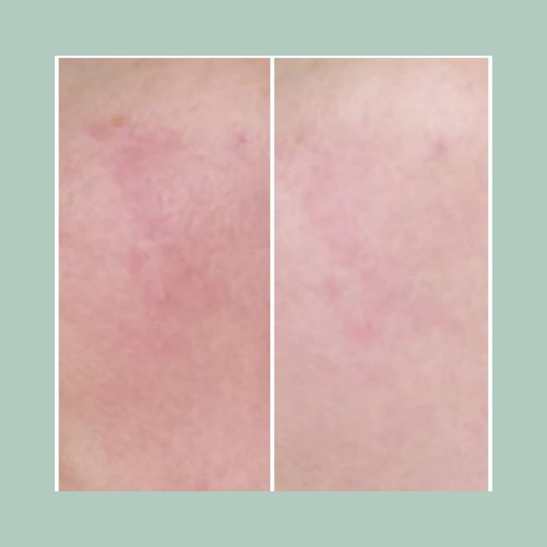 Rosacea Treatment Bundle – MGC Derma EU